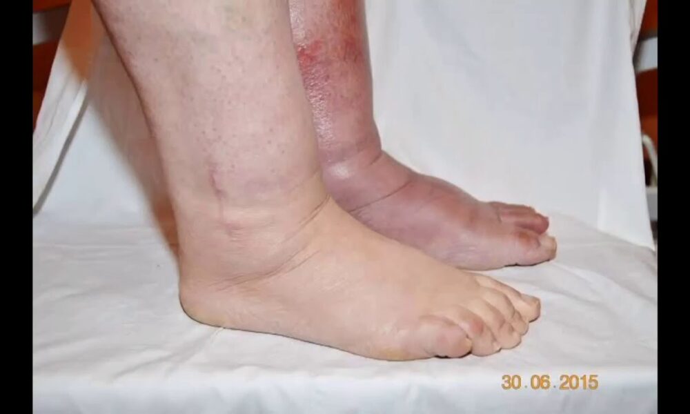 Todo sobre Linfangitis y Linfedema: Causas, Síntomas y Tratamientos ...
