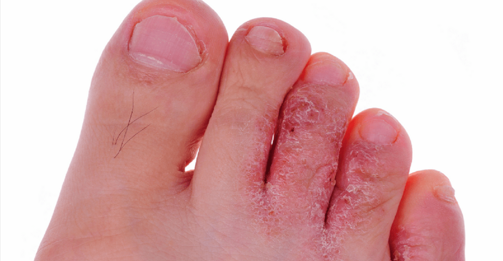 ¡Sorprendente! Deshazte de hongos y recupera tu piel – Noticito